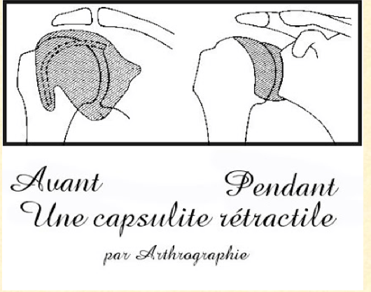 Epaule : examen et schéma capsulaire « ORTHOPEDIE POUR TOUS