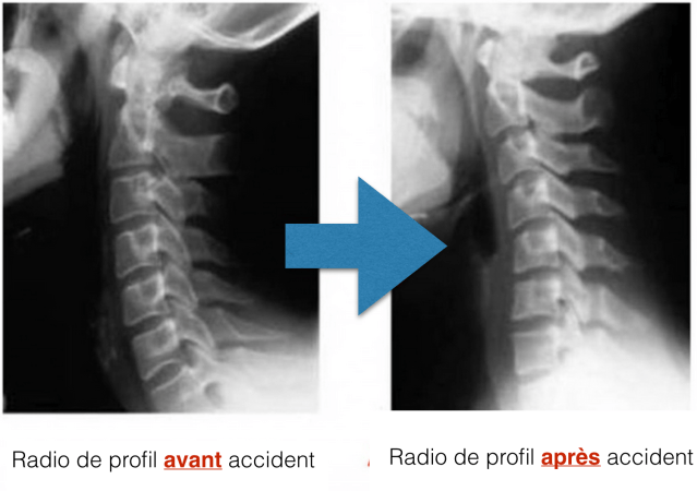 Entorses cervicale : peuvent-elles être bénignes ? « ORTHOPEDIE POUR TOUS