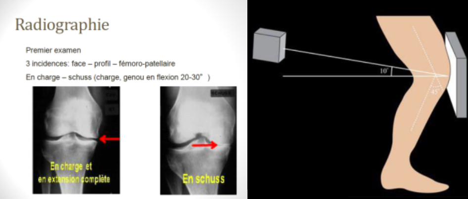 L’arthrose de genou « ORTHOPEDIE POUR TOUS
